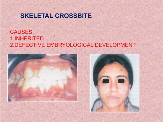 Crossbite | PPTX | Oral care | Personal Care