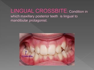 Lingual Crossbite Vs Buccal Crossbite