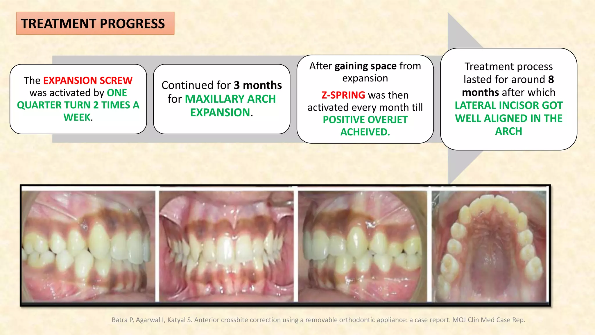 crossbite.pptx