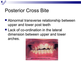 Cross bite 2 | PPT