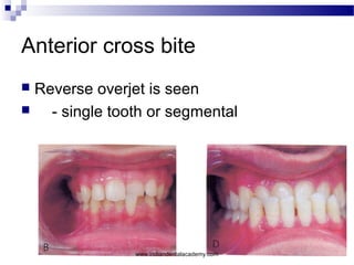 Cross bite 2 | PPT