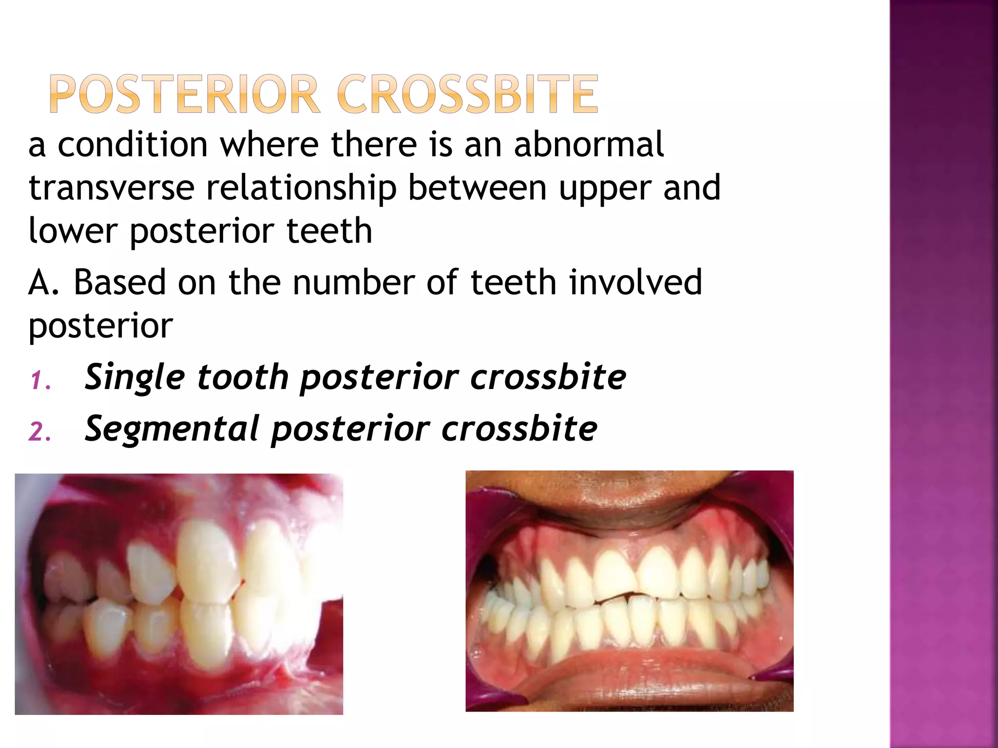 Cross bite and it's management venkat | PPTX