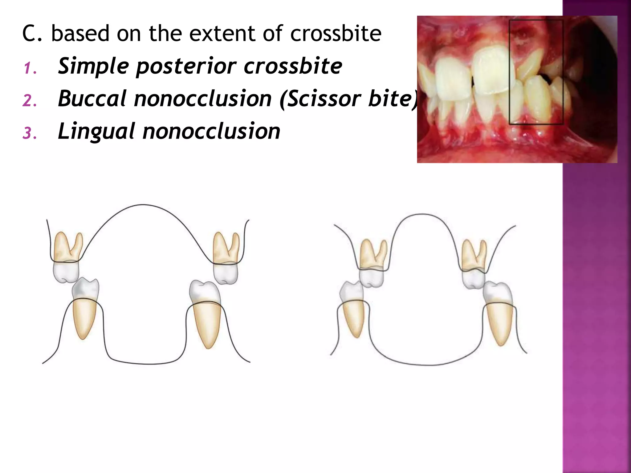 Cross bite and it's management venkat | PPTX