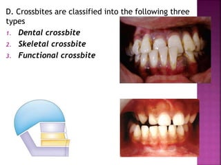Cross bite and it's management venkat | PPTX