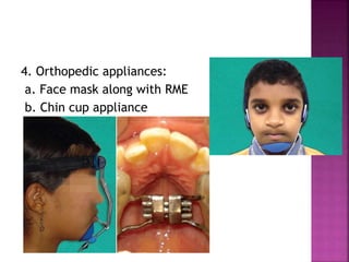 Cross bite and it's management venkat | PPTX