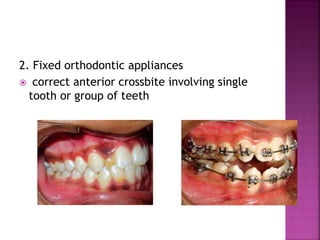 Cross bite and it's management venkat | PPTX