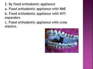 Cross bite and it's management venkat | PPTX