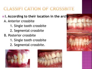 Cross bite and it's management venkat | PPTX