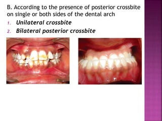 Cross bite and it's management venkat | PPTX