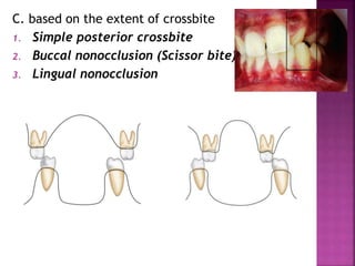 Cross bite and it's management venkat | PPTX