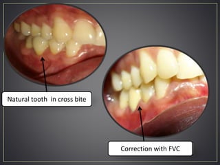 Cross bite corrected by fvc | PPTX