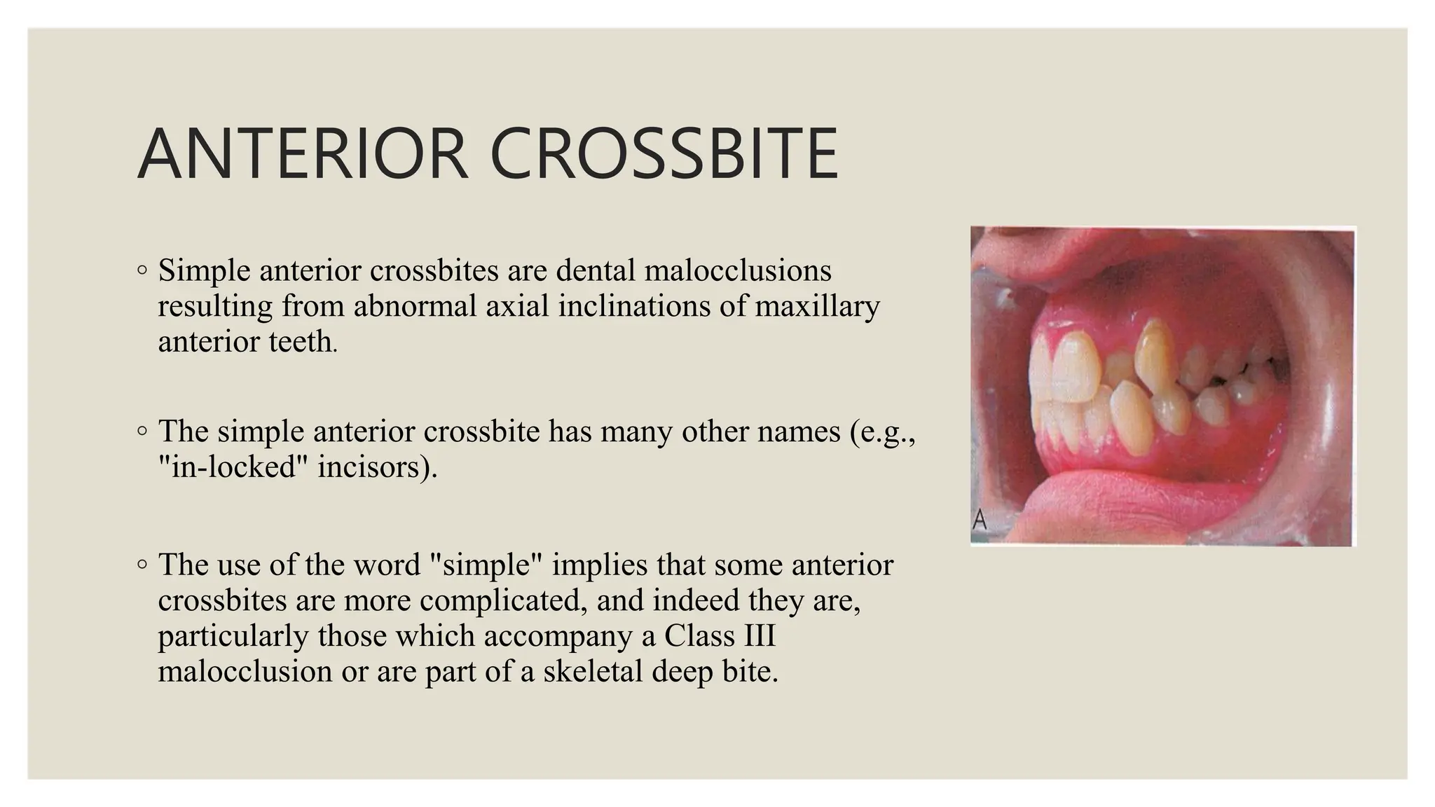 Crossbite is a form of malocclusion where a tooth (or teeth) has a more ...