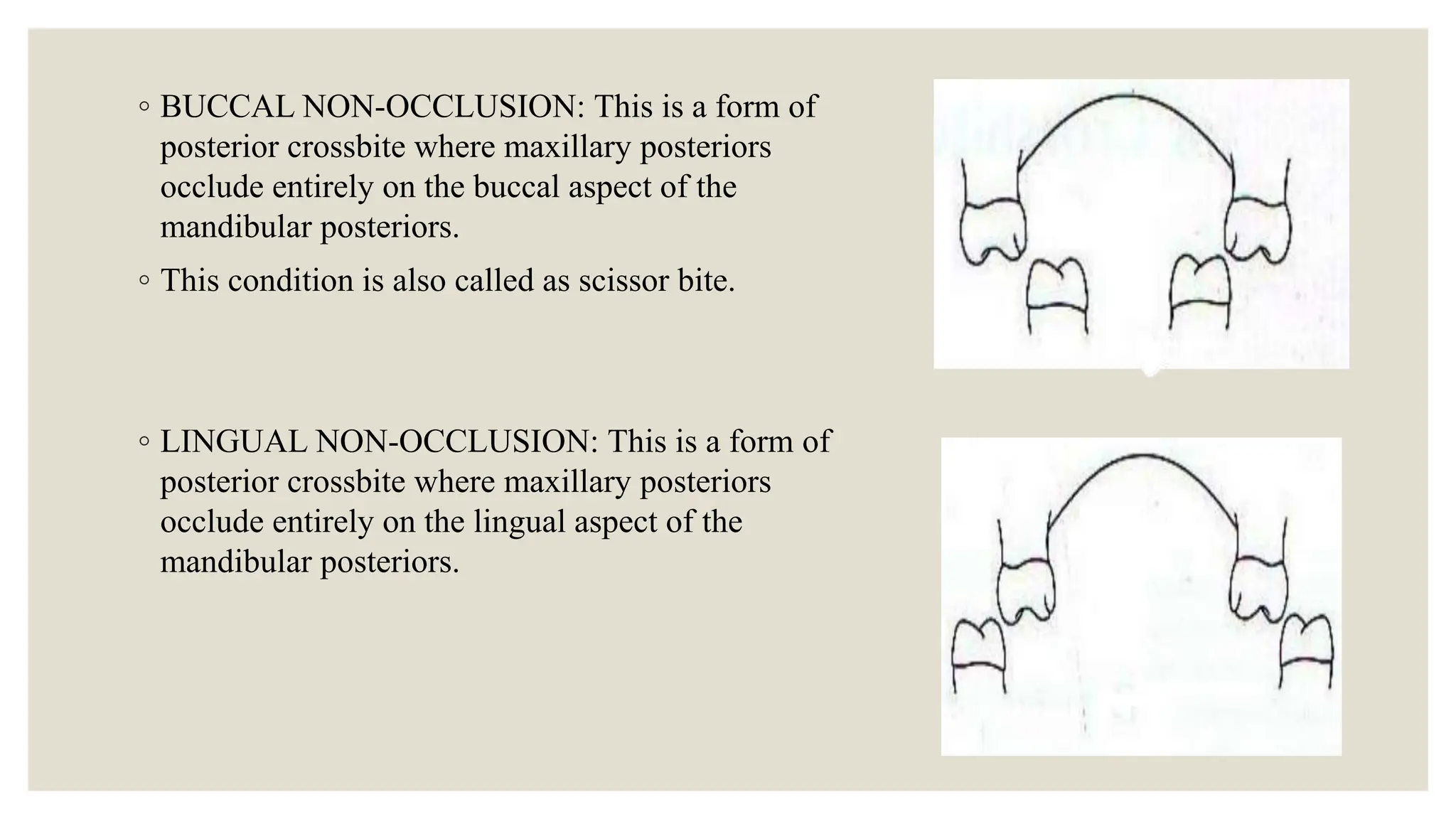 Crossbite is a form of malocclusion where a tooth (or teeth) has a more ...