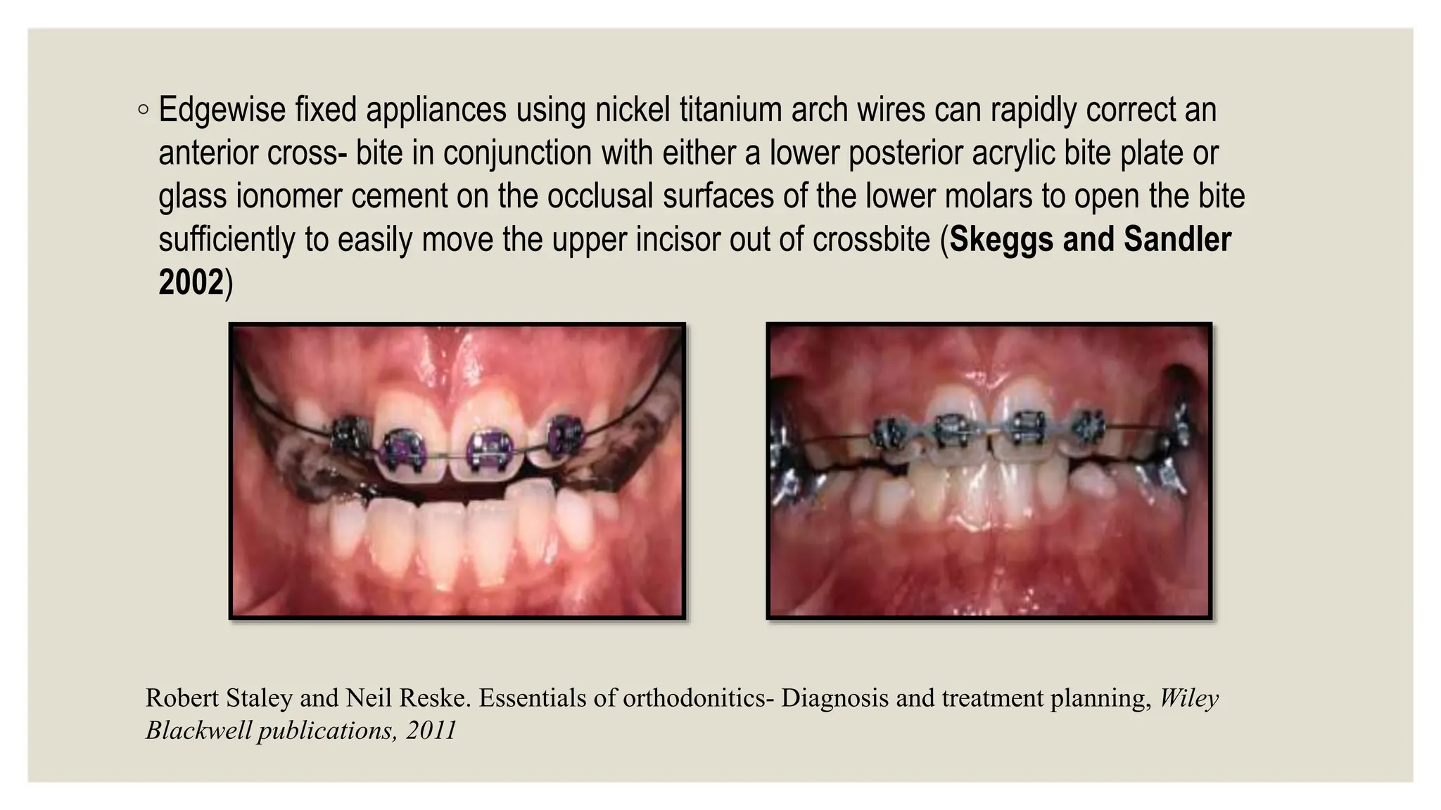 Crossbite is a form of malocclusion where a tooth (or teeth) has a more ...
