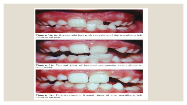 Crossbite is a form of malocclusion where a tooth (or teeth) has a more ...