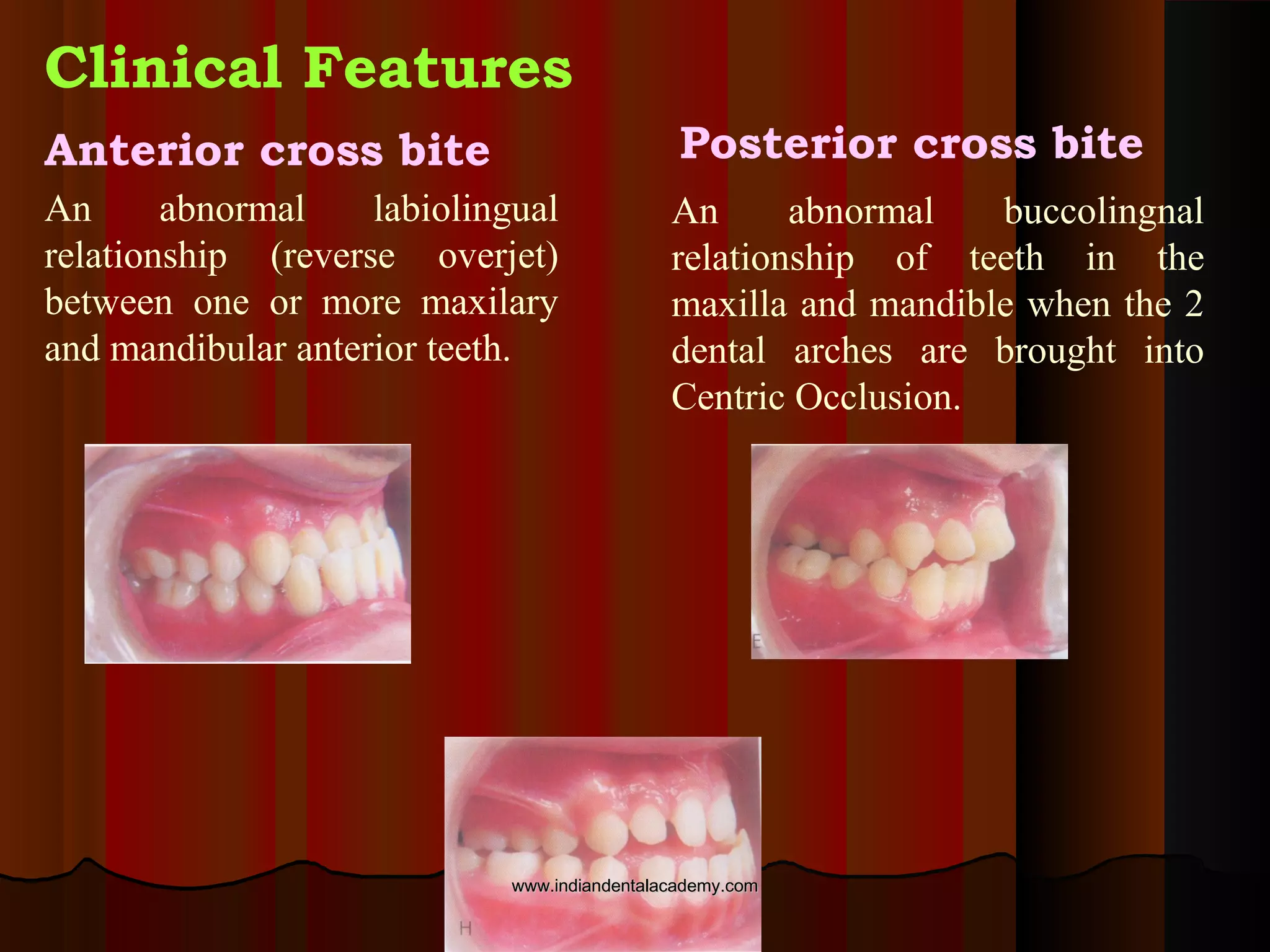 Crossbite ortho | PPT