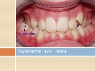 Crossbites in children | PPTX
