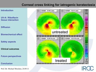 Cross linking of cornea - a review | PPT