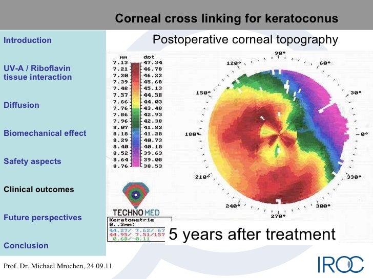 Cross linking of cornea - a review