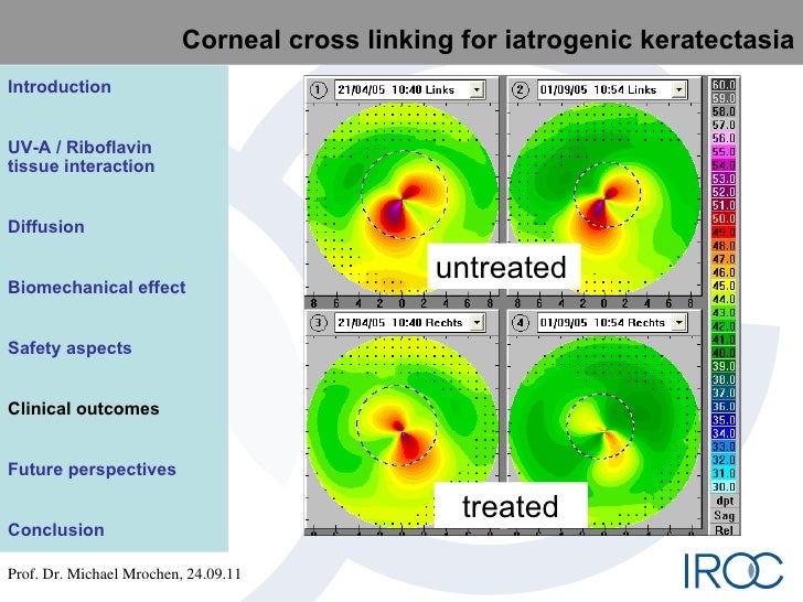 Cross linking of cornea - a review