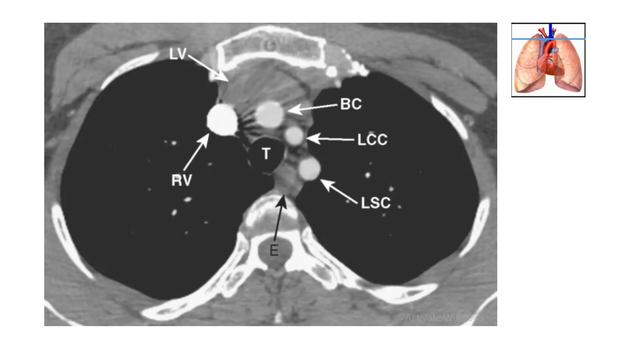 Cross sectional anatomy of chest by Dr. Milan Silwal, Resident, NAMS ...