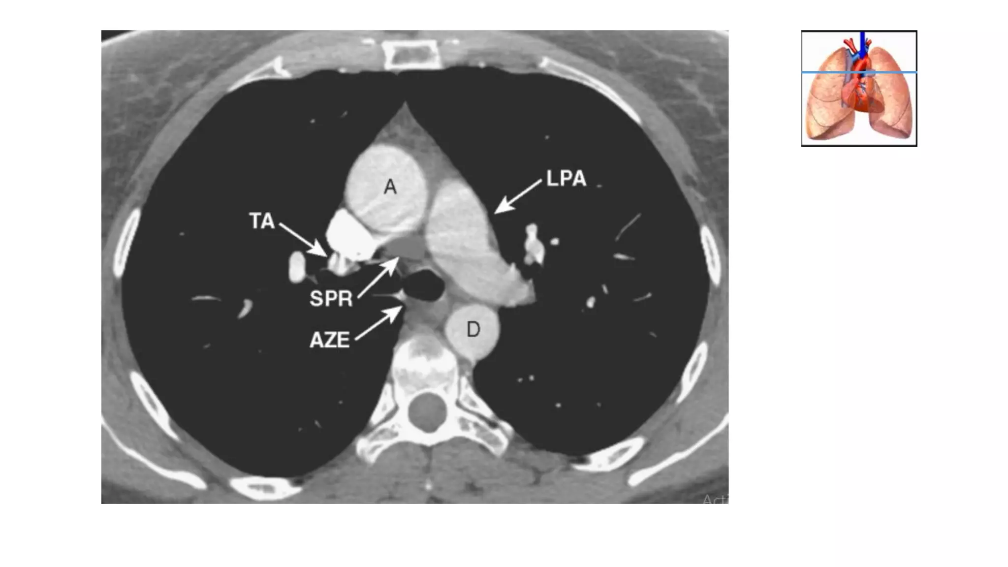 Cross sectional anatomy of chest by Dr. Milan Silwal, Resident, NAMS ...