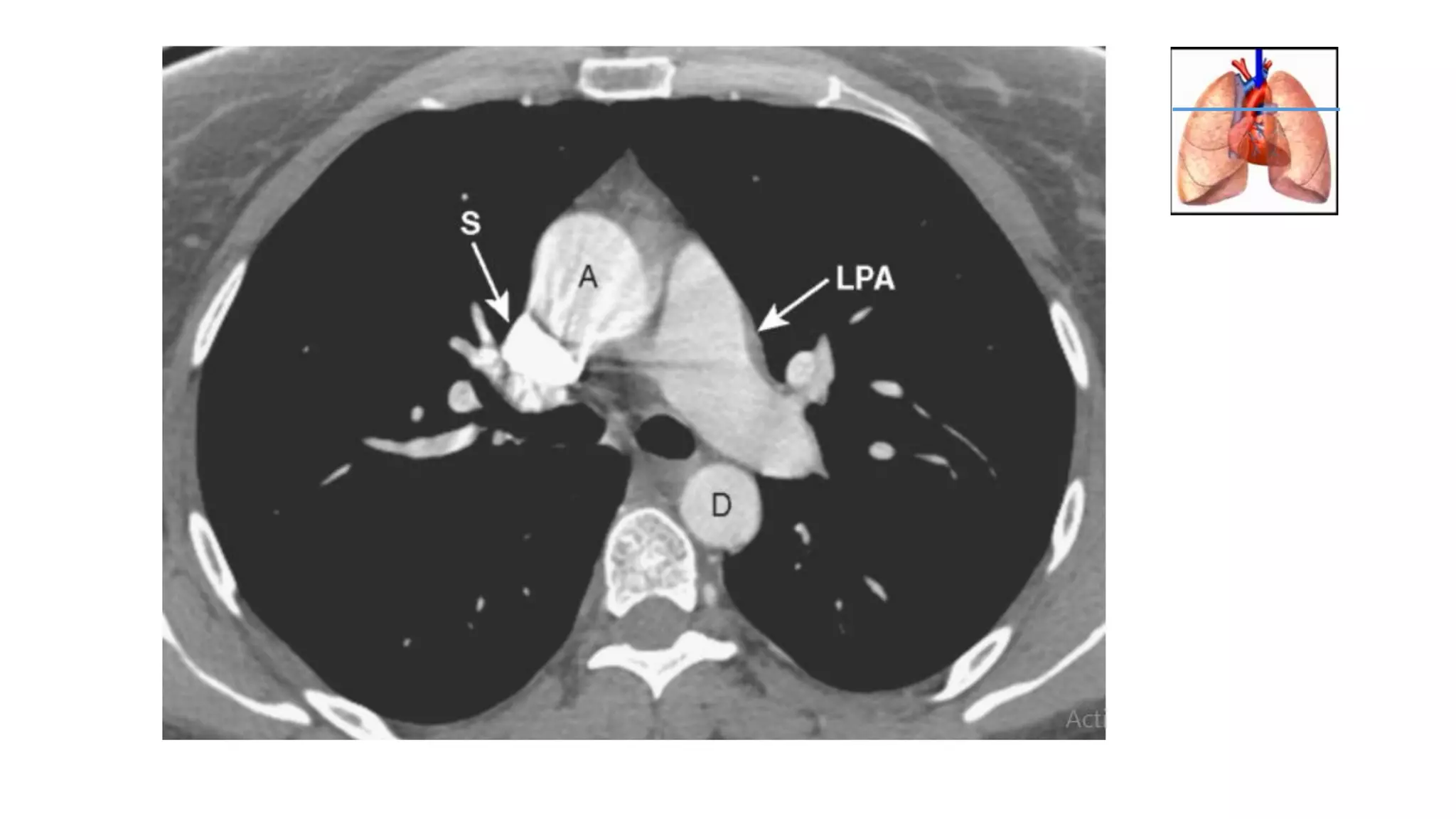 Cross sectional anatomy of chest by Dr. Milan Silwal, Resident, NAMS ...
