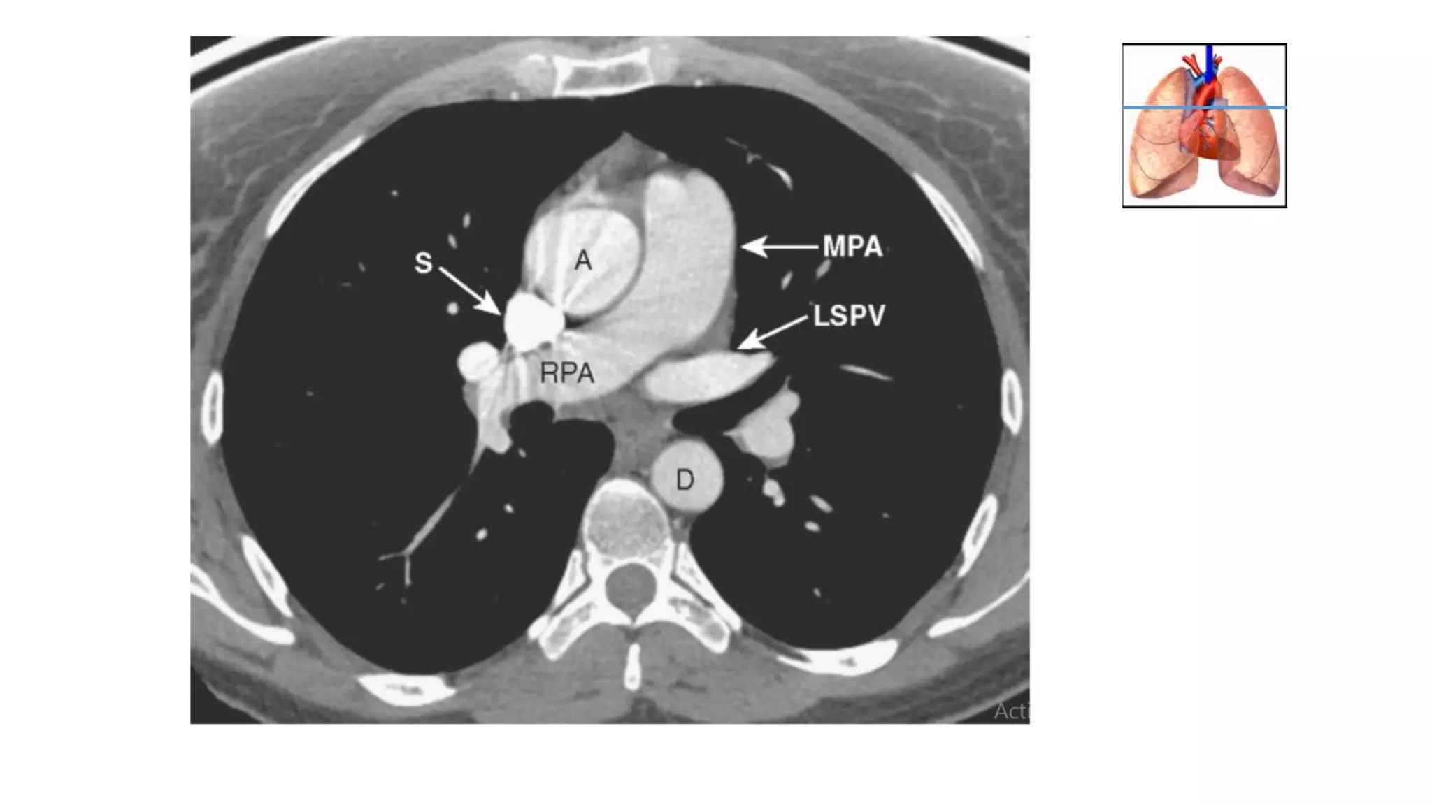 Cross sectional anatomy of chest by Dr. Milan Silwal, Resident, NAMS ...