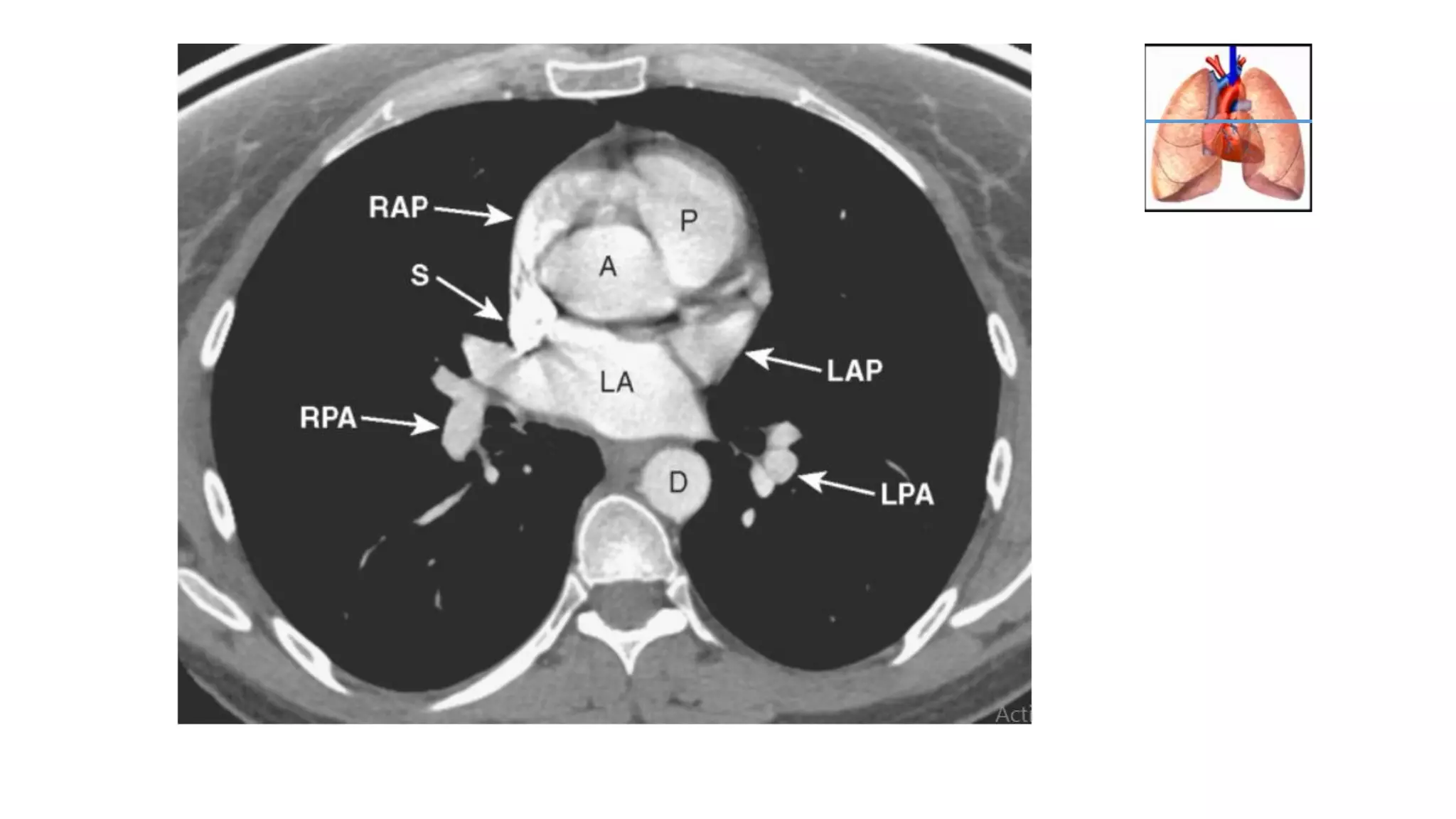 Cross sectional anatomy of chest by Dr. Milan Silwal, Resident, NAMS ...