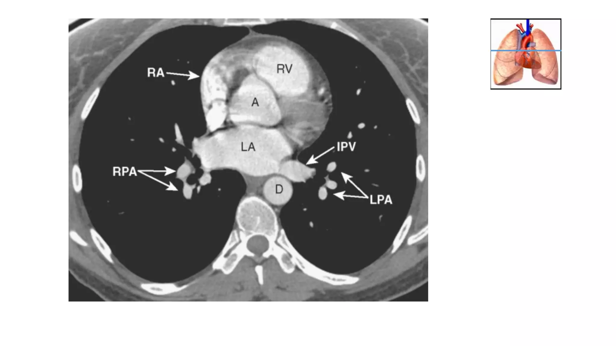 Cross sectional anatomy of chest by Dr. Milan Silwal, Resident, NAMS ...