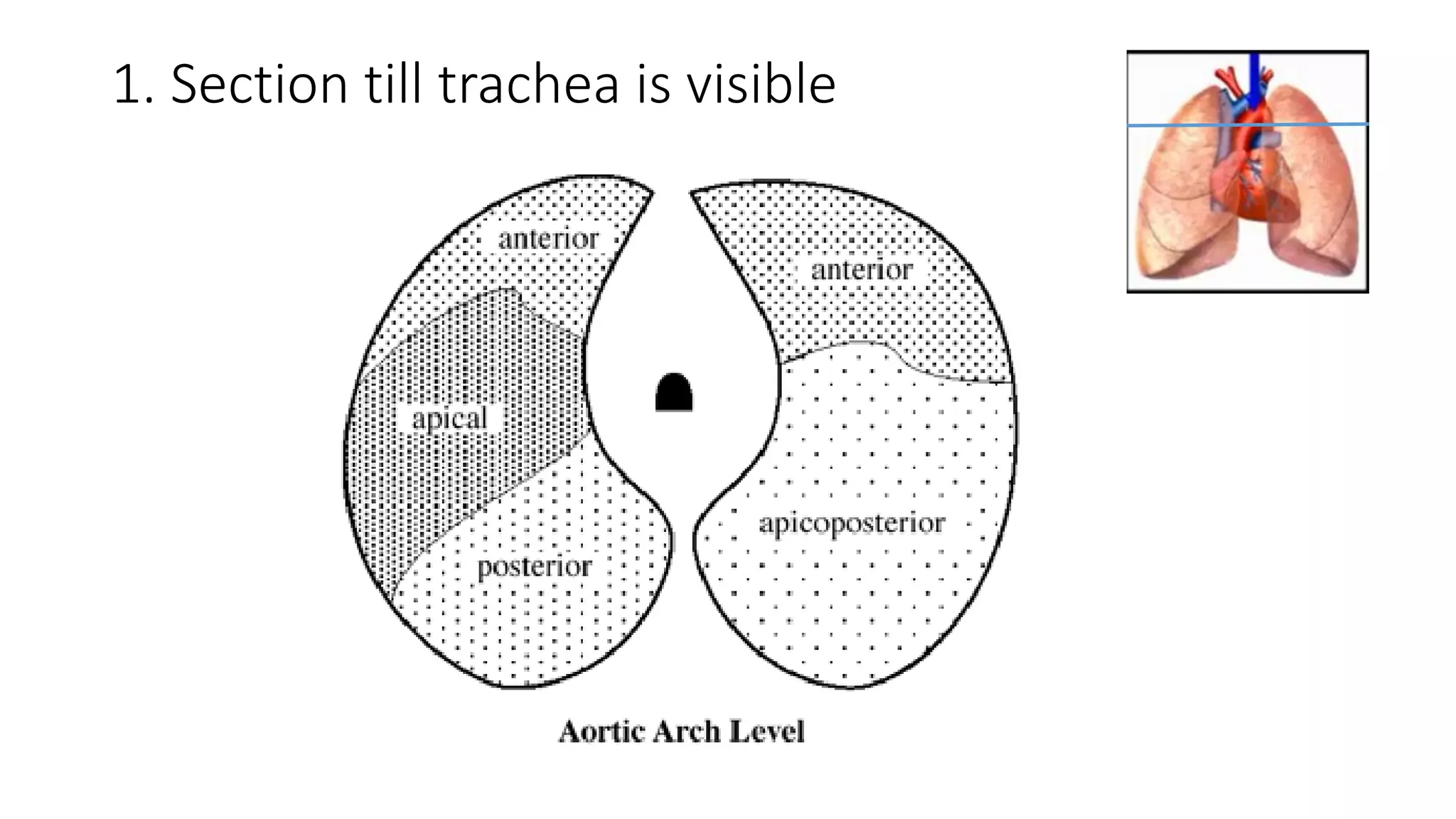 Cross sectional anatomy of chest by Dr. Milan Silwal, Resident, NAMS ...