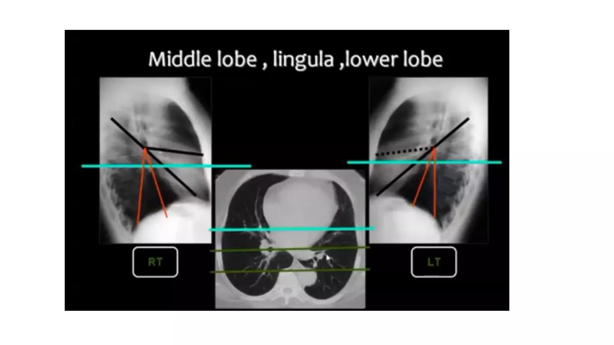 Cross sectional anatomy of chest by Dr. Milan Silwal, Resident, NAMS ...