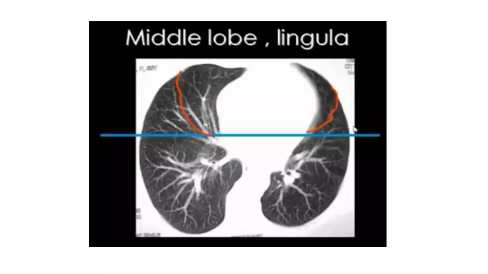 Cross sectional anatomy of chest by Dr. Milan Silwal, Resident, NAMS ...