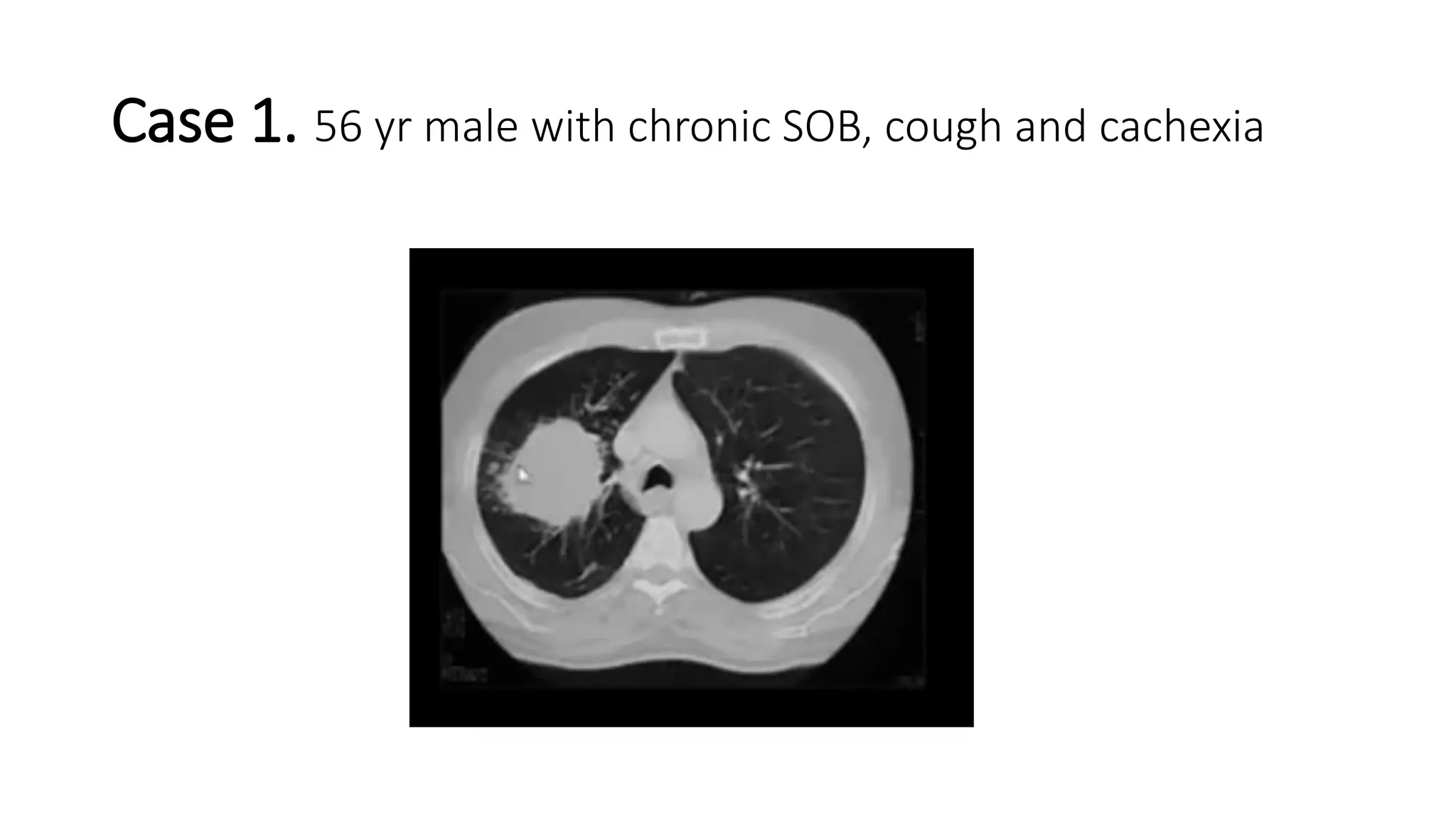 Cross sectional anatomy of chest by Dr. Milan Silwal, Resident, NAMS ...