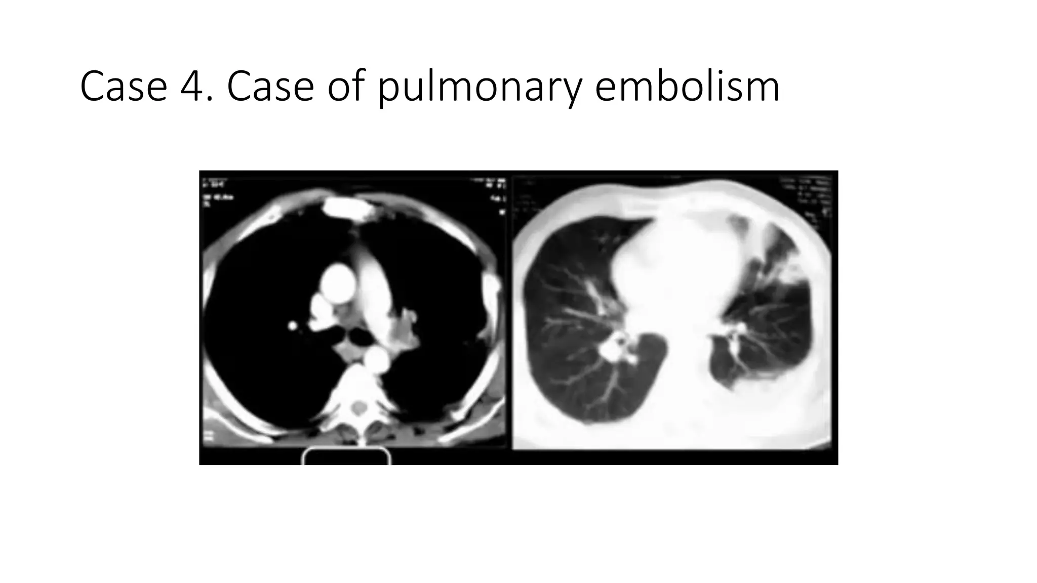 Cross sectional anatomy of chest by Dr. Milan Silwal, Resident, NAMS ...
