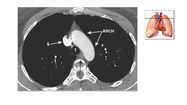 Cross sectional anatomy of chest by Dr. Milan Silwal, Resident, NAMS ...