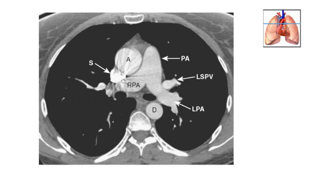 Cross sectional anatomy of chest by Dr. Milan Silwal, Resident, NAMS ...
