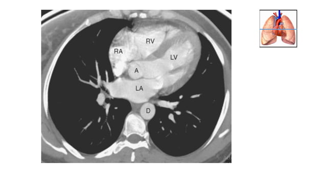 Cross sectional anatomy of chest by Dr. Milan Silwal, Resident, NAMS ...