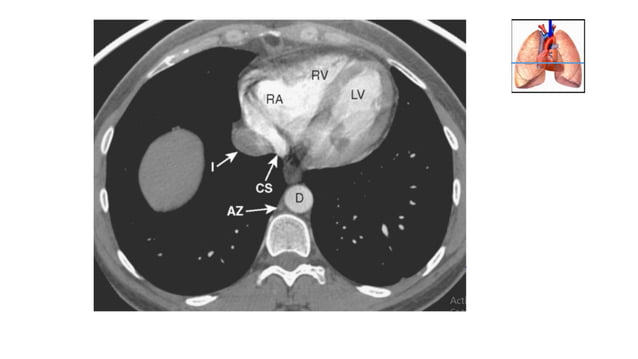 Cross sectional anatomy of chest by Dr. Milan Silwal, Resident, NAMS ...