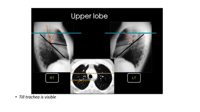 Cross sectional anatomy of chest by Dr. Milan Silwal, Resident, NAMS ...