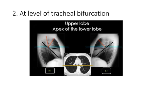 Cross sectional anatomy of chest by Dr. Milan Silwal, Resident, NAMS ...