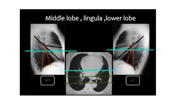 Cross sectional anatomy of chest by Dr. Milan Silwal, Resident, NAMS ...