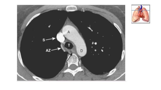 Cross sectional anatomy of chest by Dr. Milan Silwal, Resident, NAMS,…