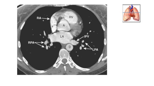 Cross sectional anatomy of chest by Dr. Milan Silwal, Resident, NAMS,…