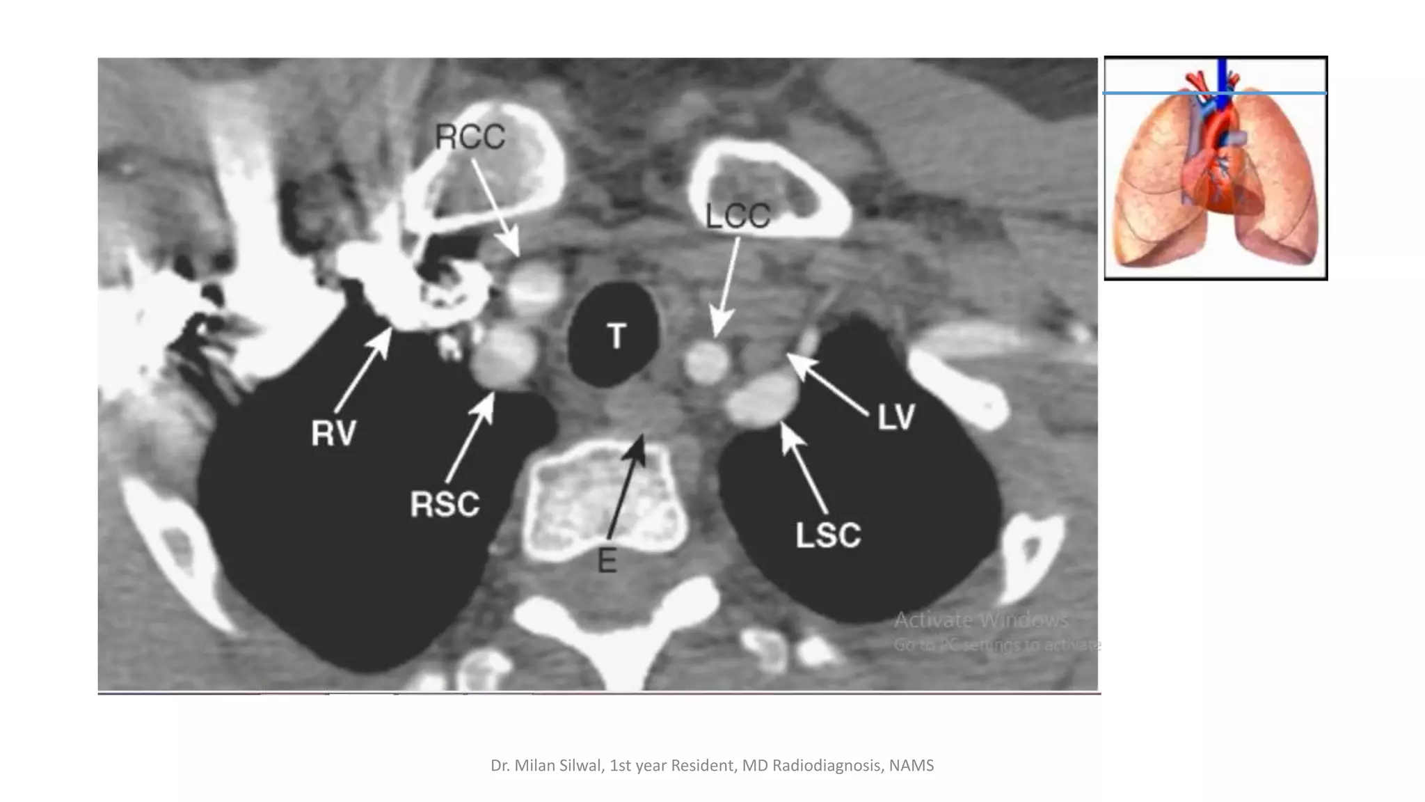 Cross sectional anatomy of chest by Dr. Milan | PPTX
