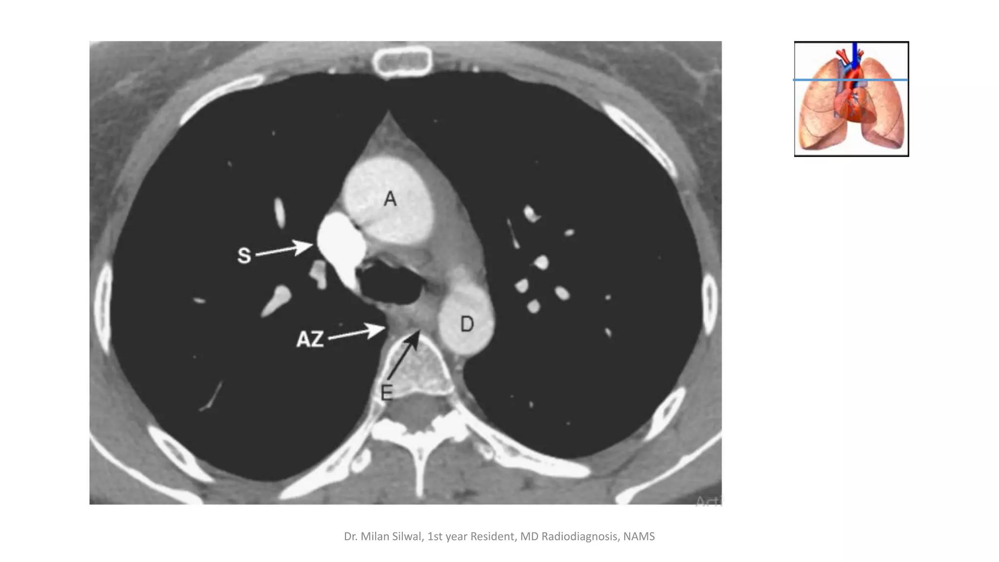 Cross sectional anatomy of chest by Dr. Milan | PPTX