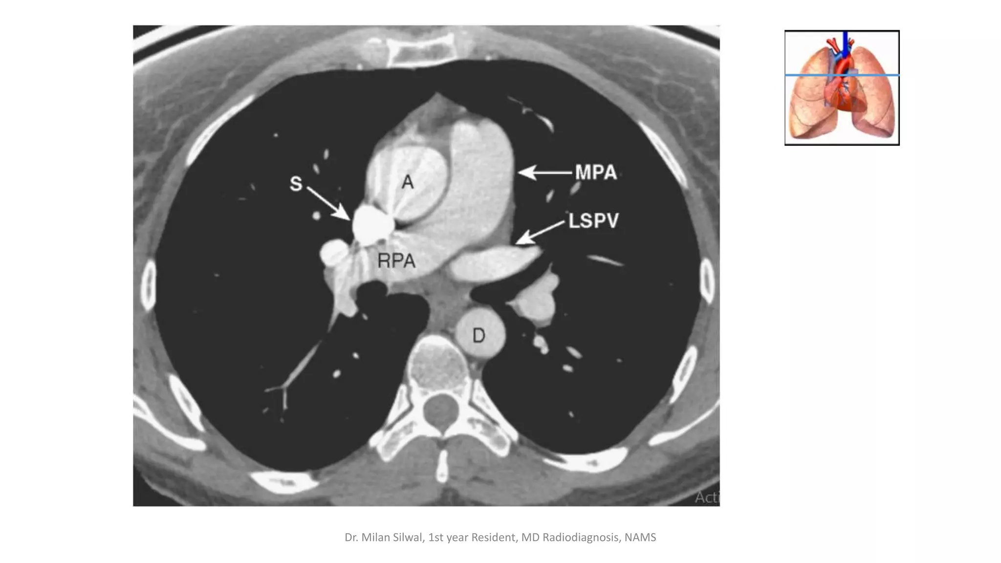 Cross sectional anatomy of chest by Dr. Milan | PPTX