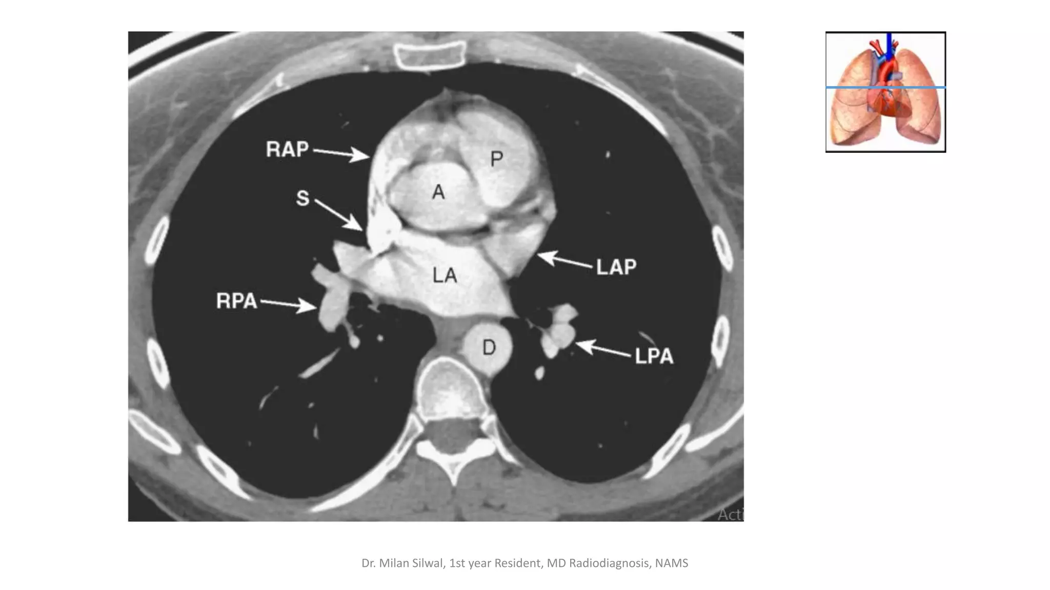 Cross sectional anatomy of chest by Dr. Milan | PPTX
