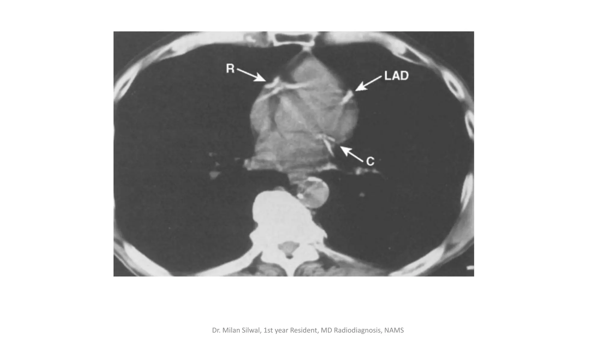 Cross sectional anatomy of chest by Dr. Milan | PPTX