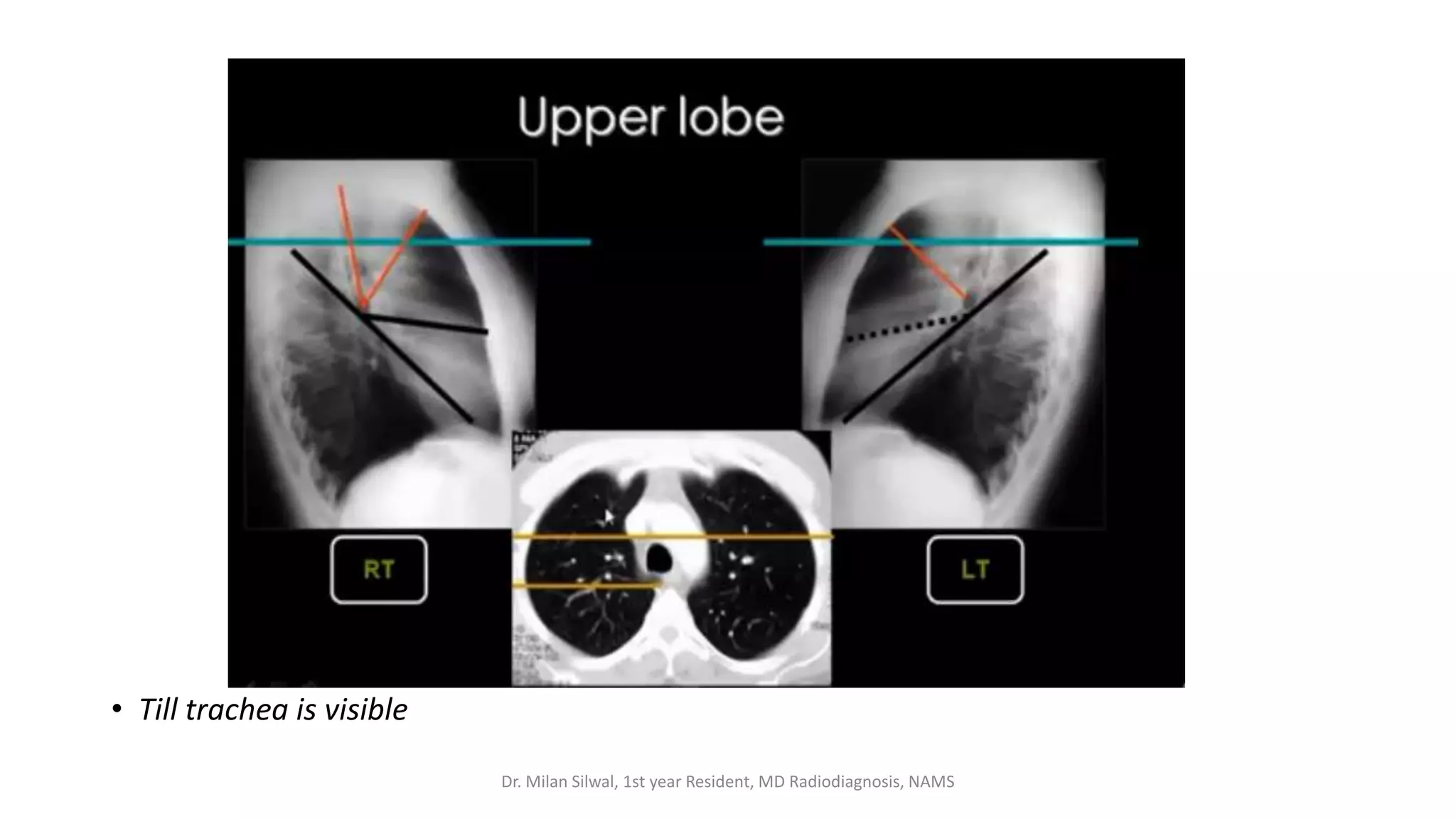 Cross sectional anatomy of chest by Dr. Milan | PPTX